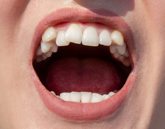 Can Cosmetic Dentistry Fix Uneven Teeth?